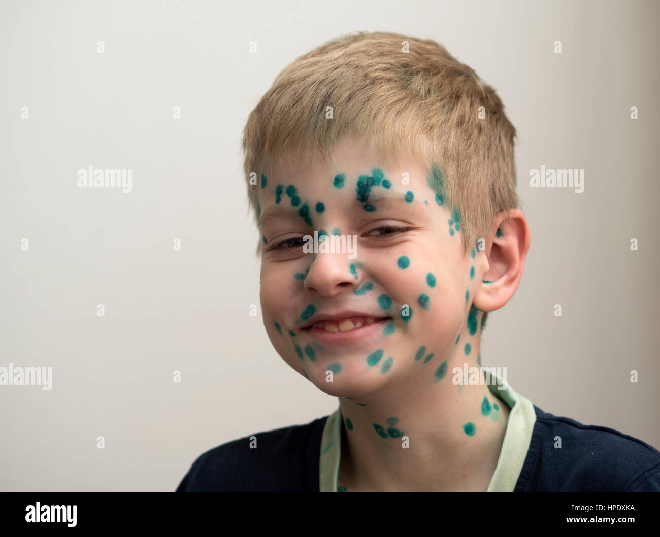 Virus varicelle-zona ou de la varicelle bubble éruption sur enfant ...