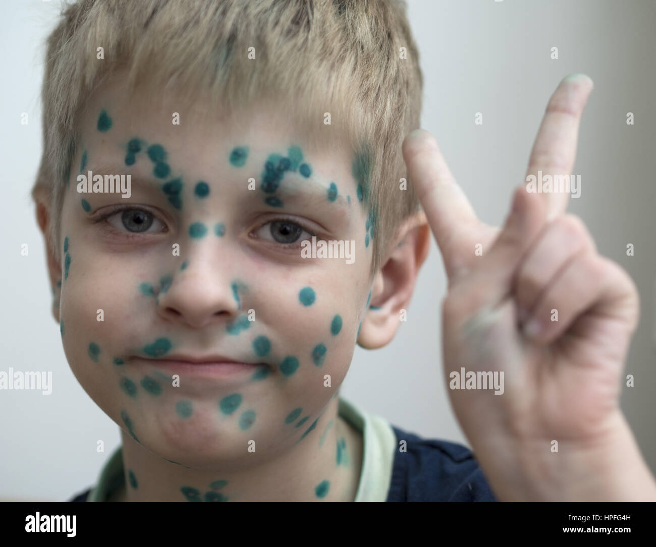 Enfant Avec Varicelle Banque d'image et photos - Alamy