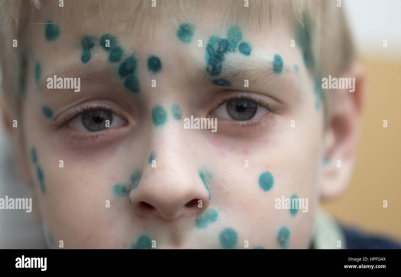 Enfant Avec Varicelle Banque d'image et photos - Alamy