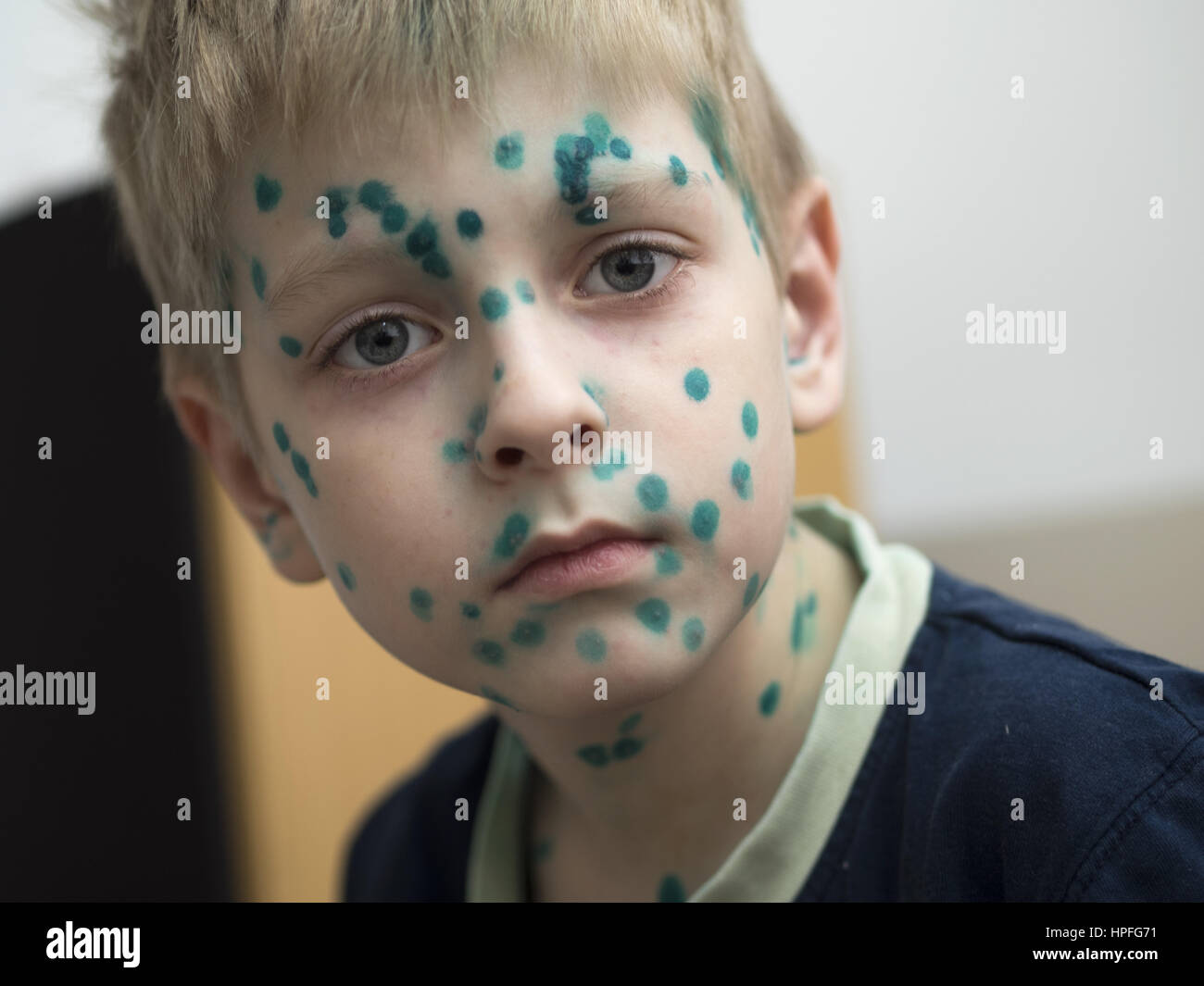 Enfant Avec Varicelle Banque d'image et photos - Alamy