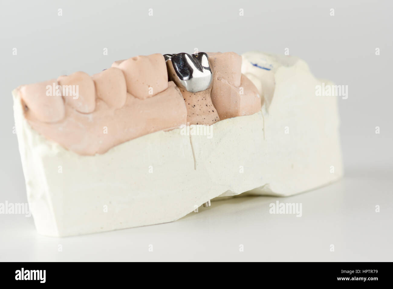 La couronne dentaire en métal moulé sur modèle en plâtre artificiel ...