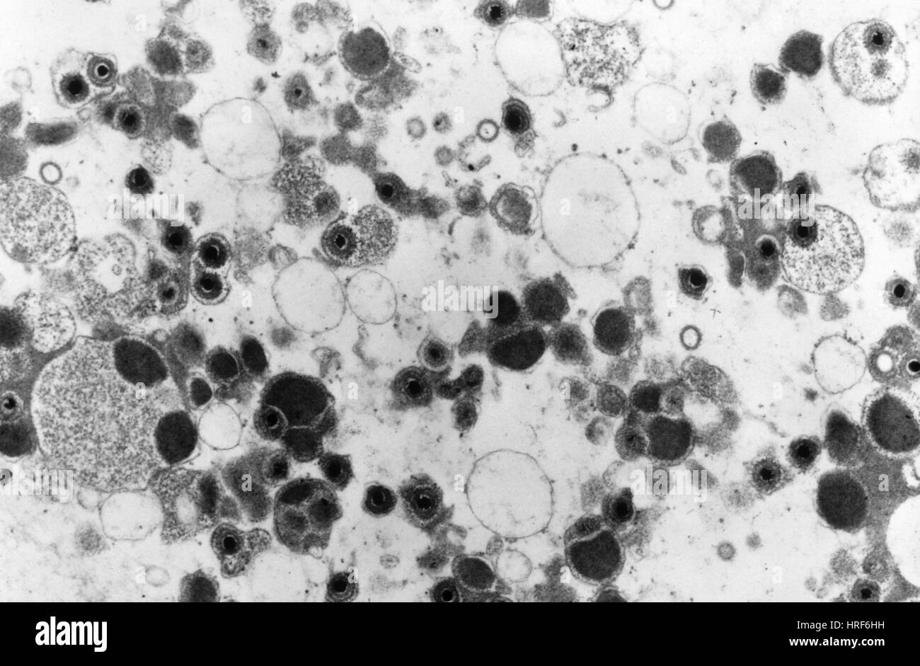Virus de la inmunodeficiencia humana vih sida Banque d'images noir et ...