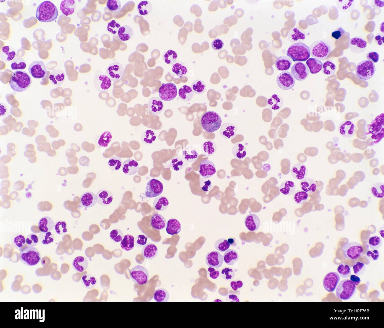 Leucémie granulocytaire chronique Banque de photographies et d’images à ...