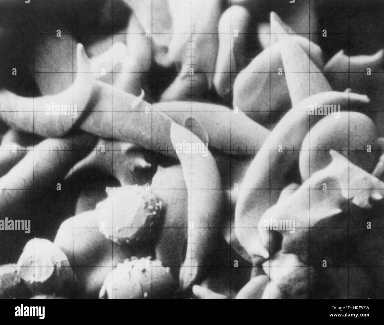 Sickle cell anemia drepanocytosis Banque de photographies et d’images à ...