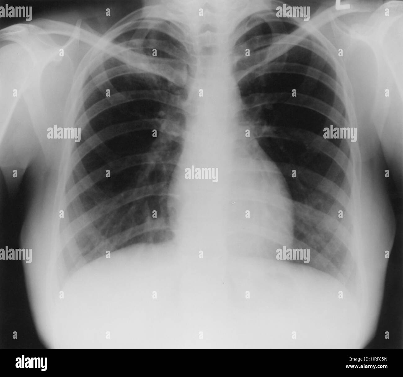 Coeur et poumons humains Banque d'images noir et blanc - Alamy