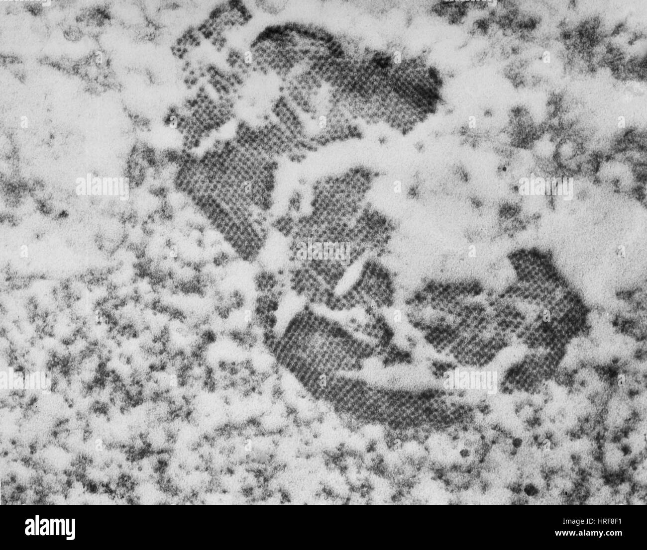 Poliomyelitis viral infection polio Banque de photographies et d’images ...