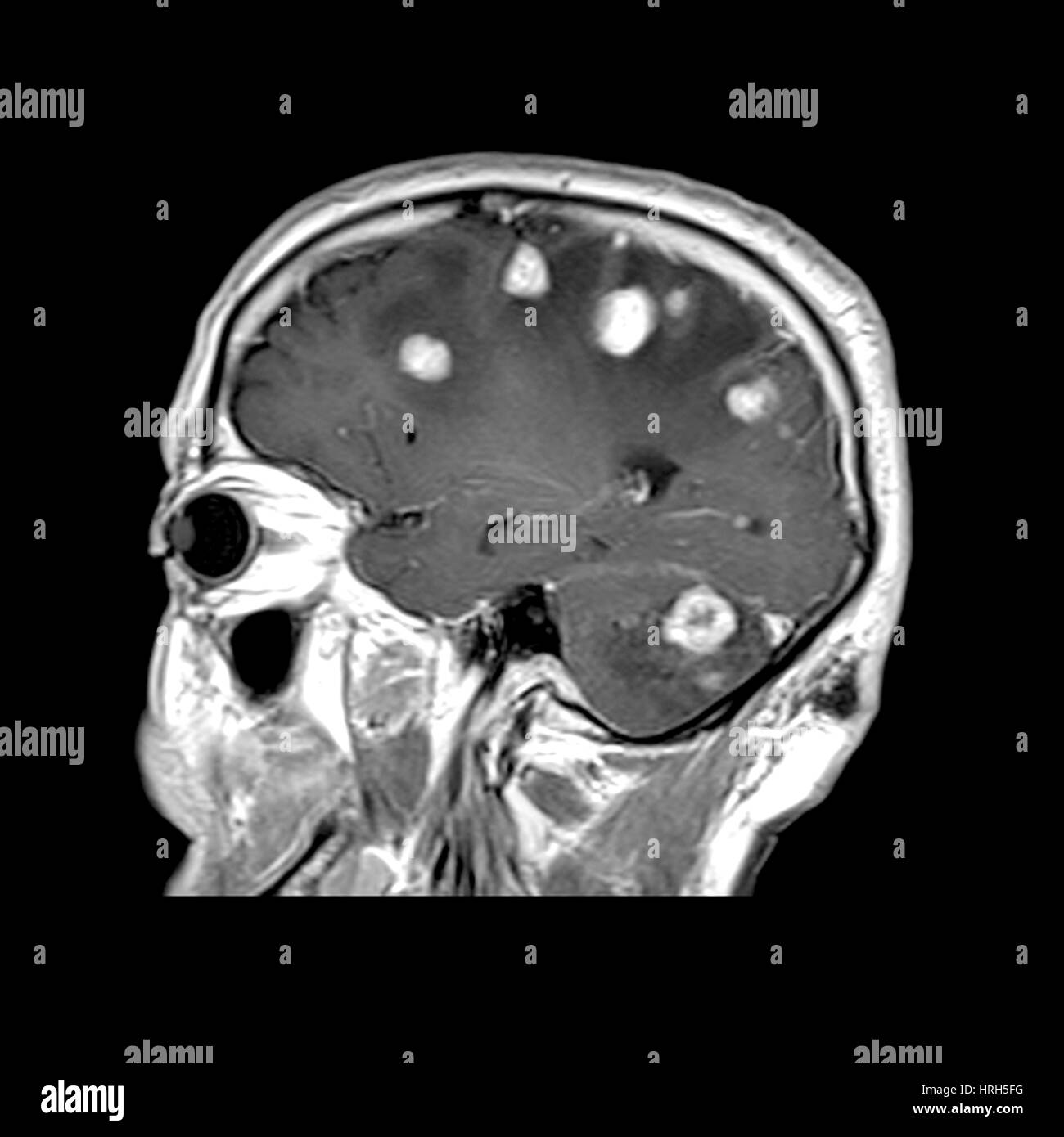 Irm de tumeur au cerveau Banque d'images noir et blanc - Alamy