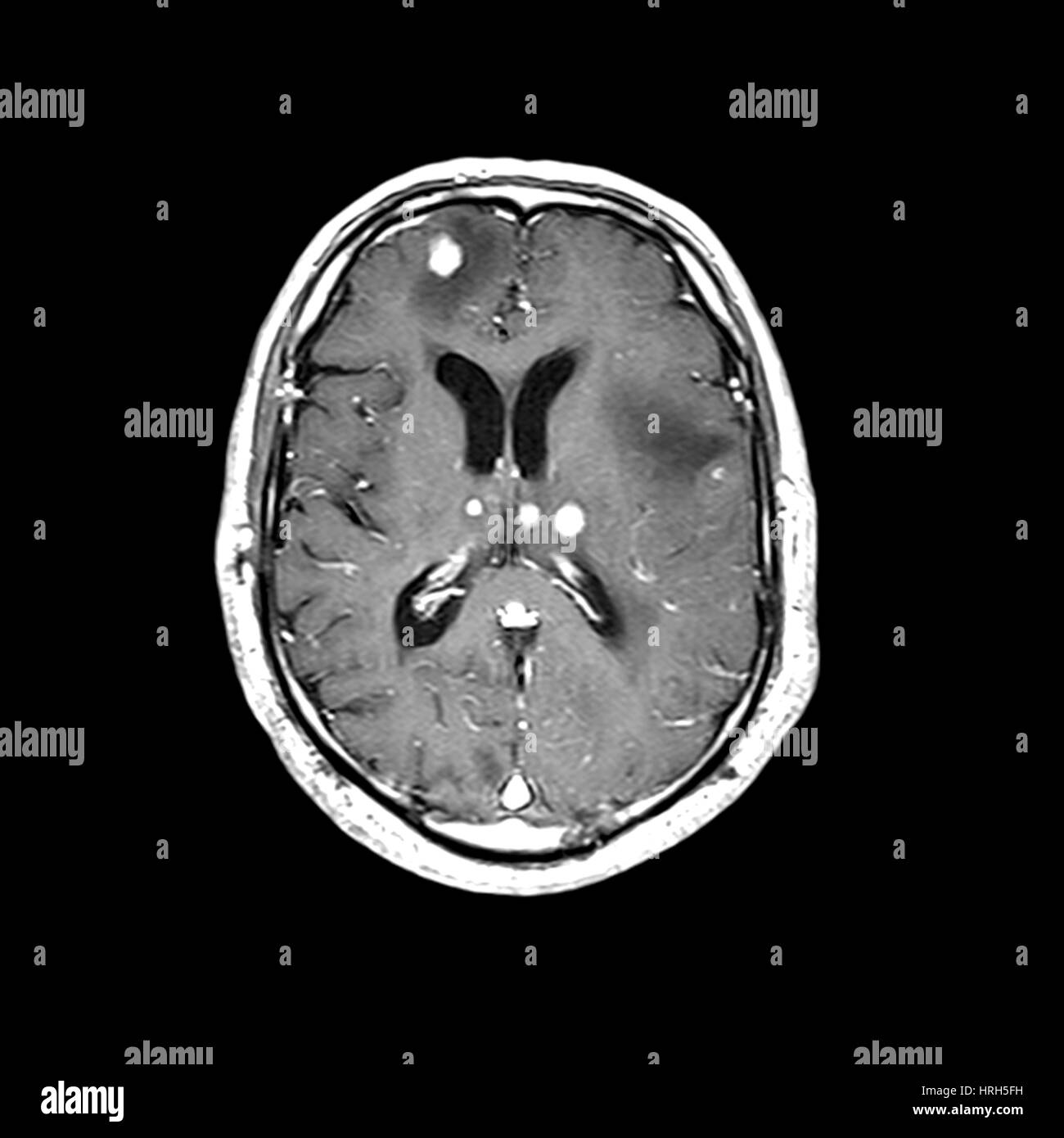 Irm de tumeur au cerveau Banque d'images noir et blanc - Alamy