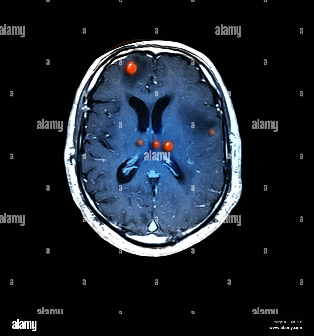 Irm anormal du cerveau Banque de photographies et d’images à haute résolution - Page 2 - Alamy