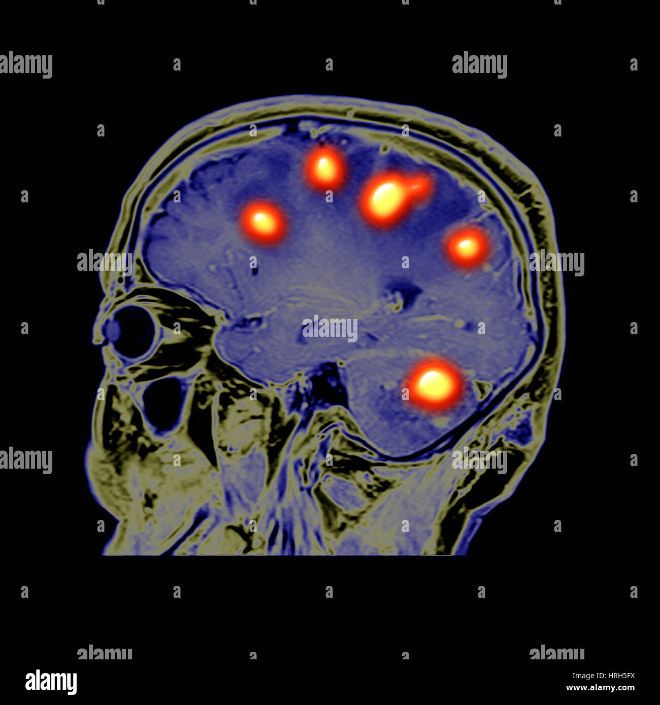 Irm anormal du cerveau Banque de photographies et d’images à haute résolution - Page 2 - Alamy