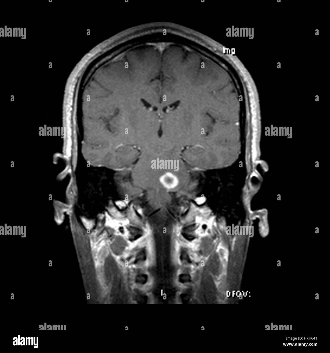 Irm de la sclérose en plaques Banque de photographies et d’images à ...