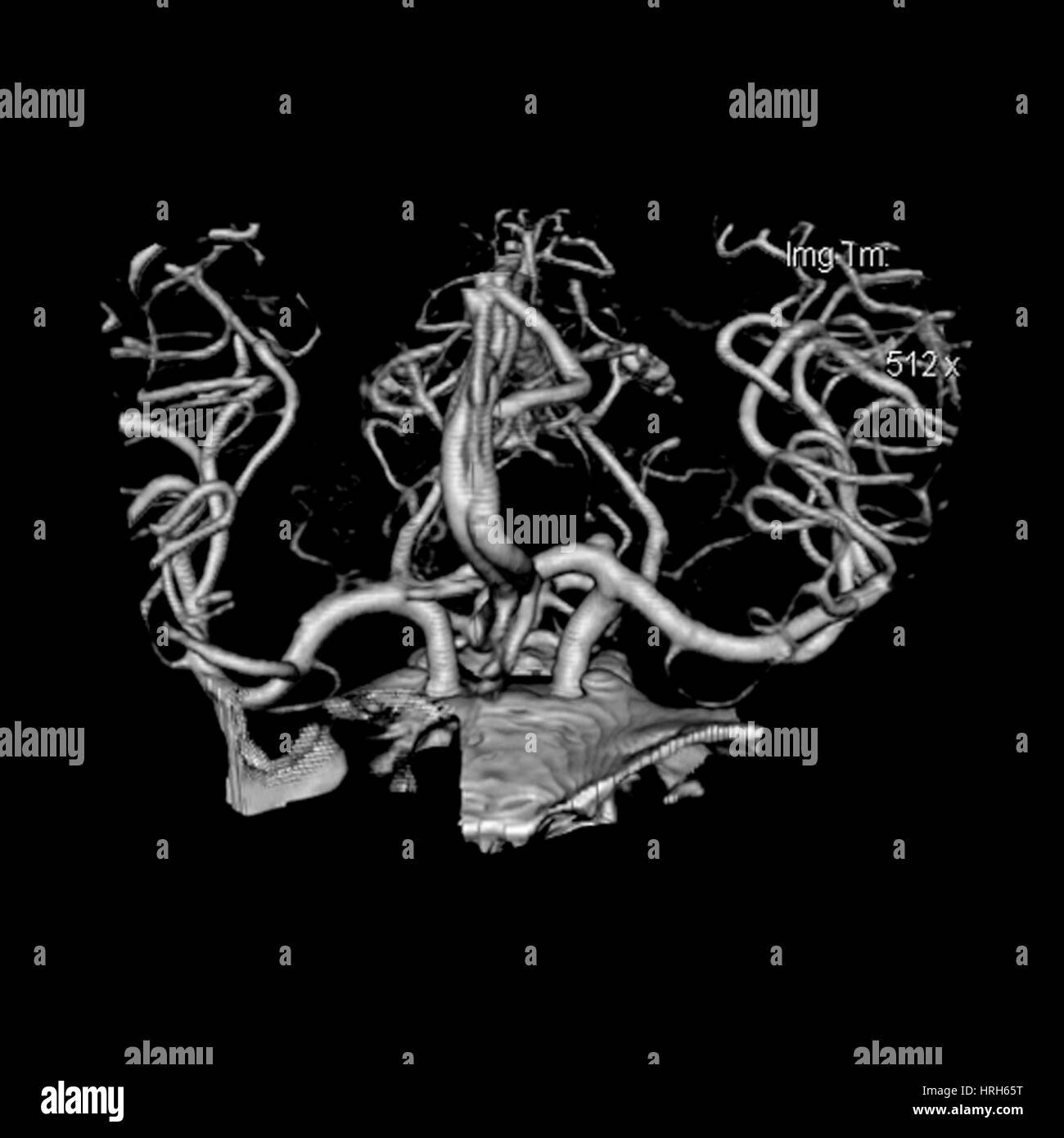 Ct Angiographie Banque d'image et photos - Alamy