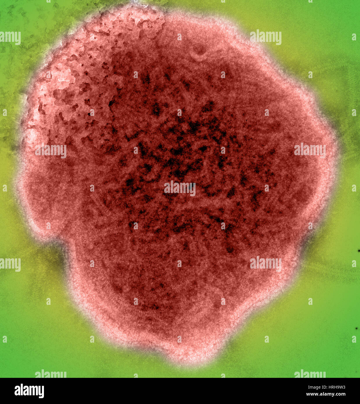 Parotidite des oreillons Banque de photographies et d’images à haute ...