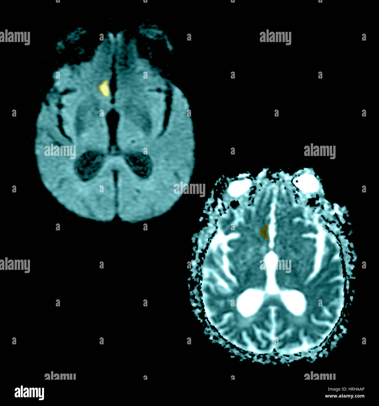 Irm anormal du cerveau Banque de photographies et d’images à haute résolution - Page 2 - Alamy