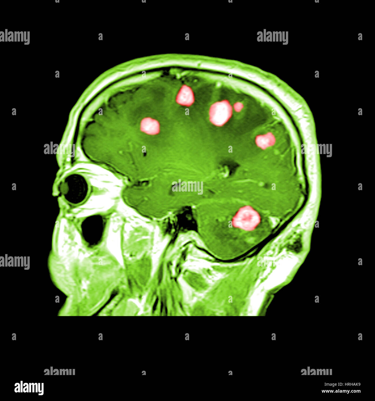 Irm anormal du cerveau Banque de photographies et d’images à haute résolution - Page 2 - Alamy
