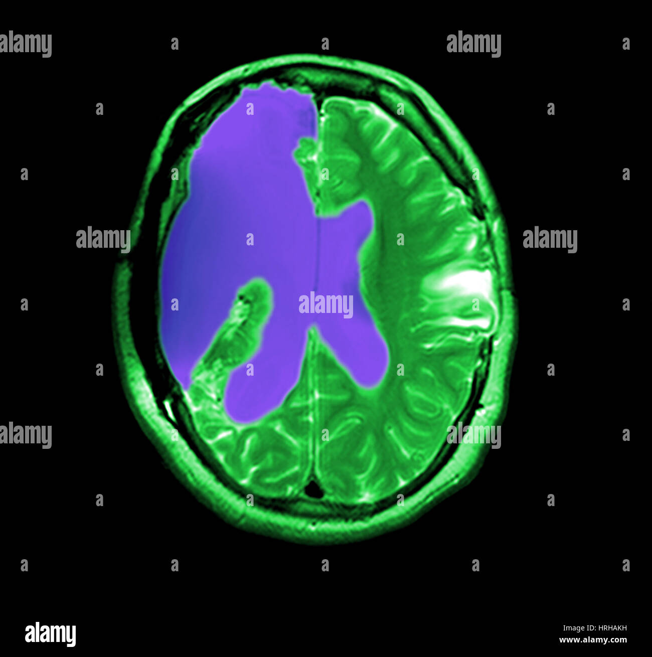 Irm anormal du cerveau Banque de photographies et d’images à haute résolution - Page 2 - Alamy