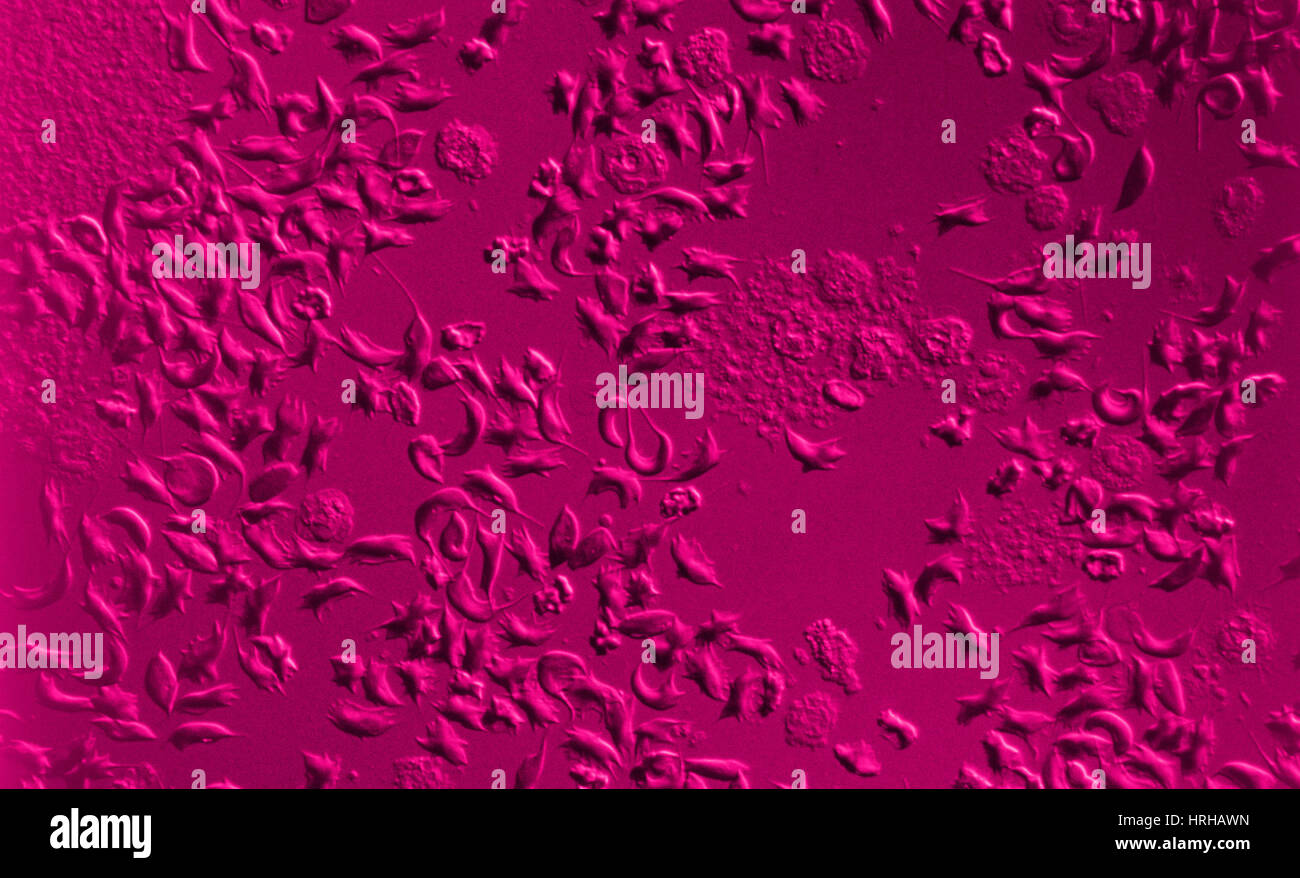 Sickle cell anemia drepanocytosis Banque de photographies et d’images à ...