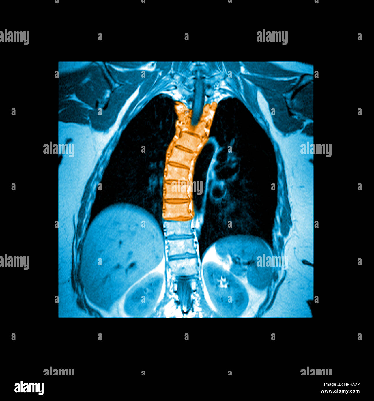 L'IRM de scoliose thoracique Photo Stock - Alamy