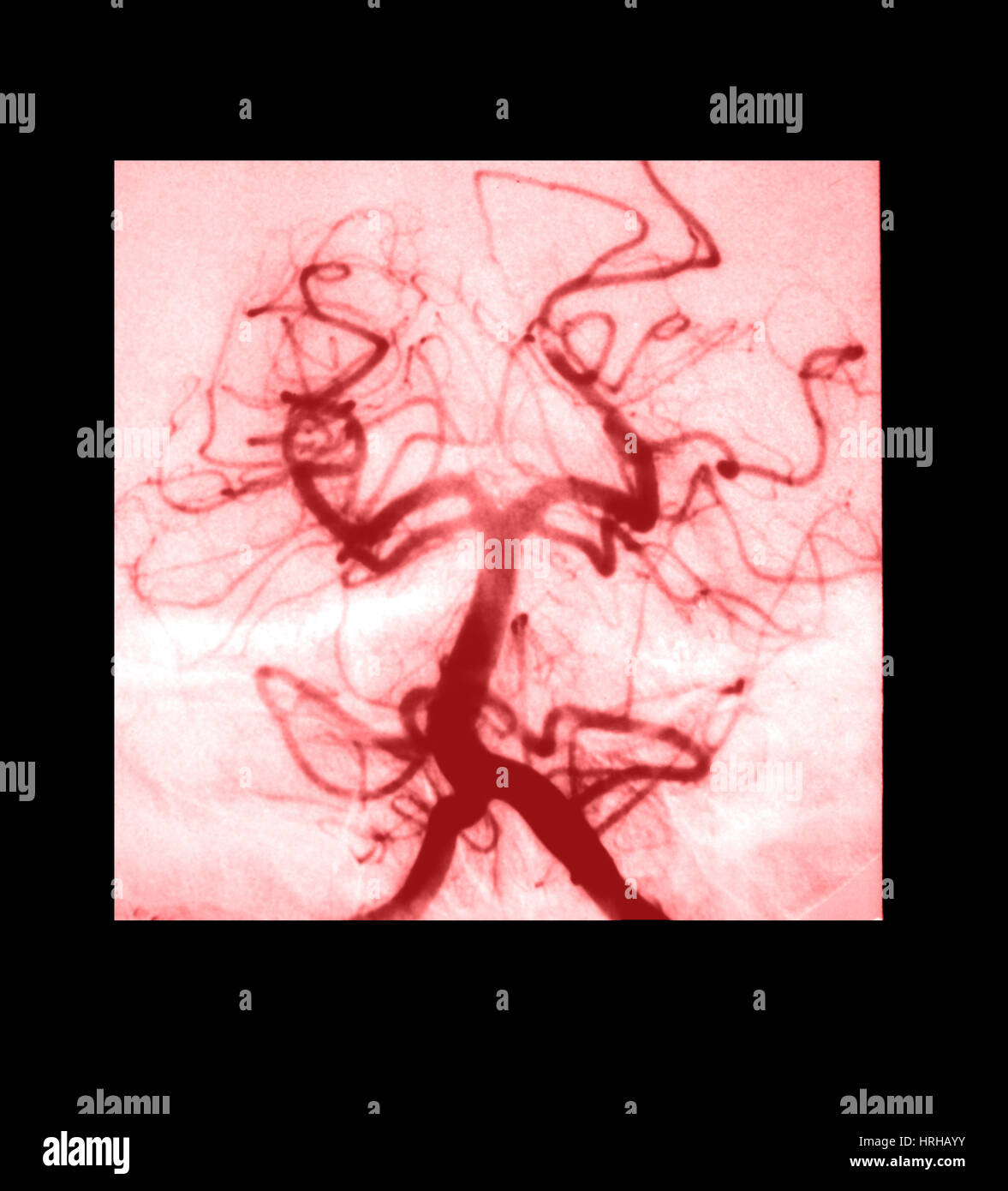 Angiograma De La Arteria Cerebral Posterior Anormal Banque De