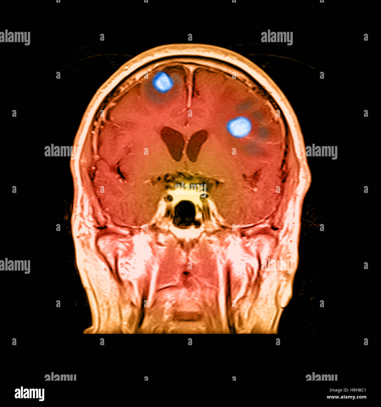 Irm anormal du cerveau Banque de photographies et d’images à haute résolution - Page 2 - Alamy