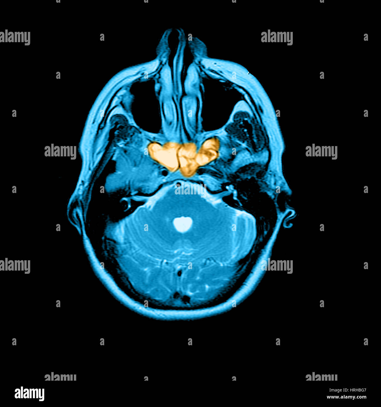 Sinus scan Banque de photographies et d’images à haute résolution - Alamy