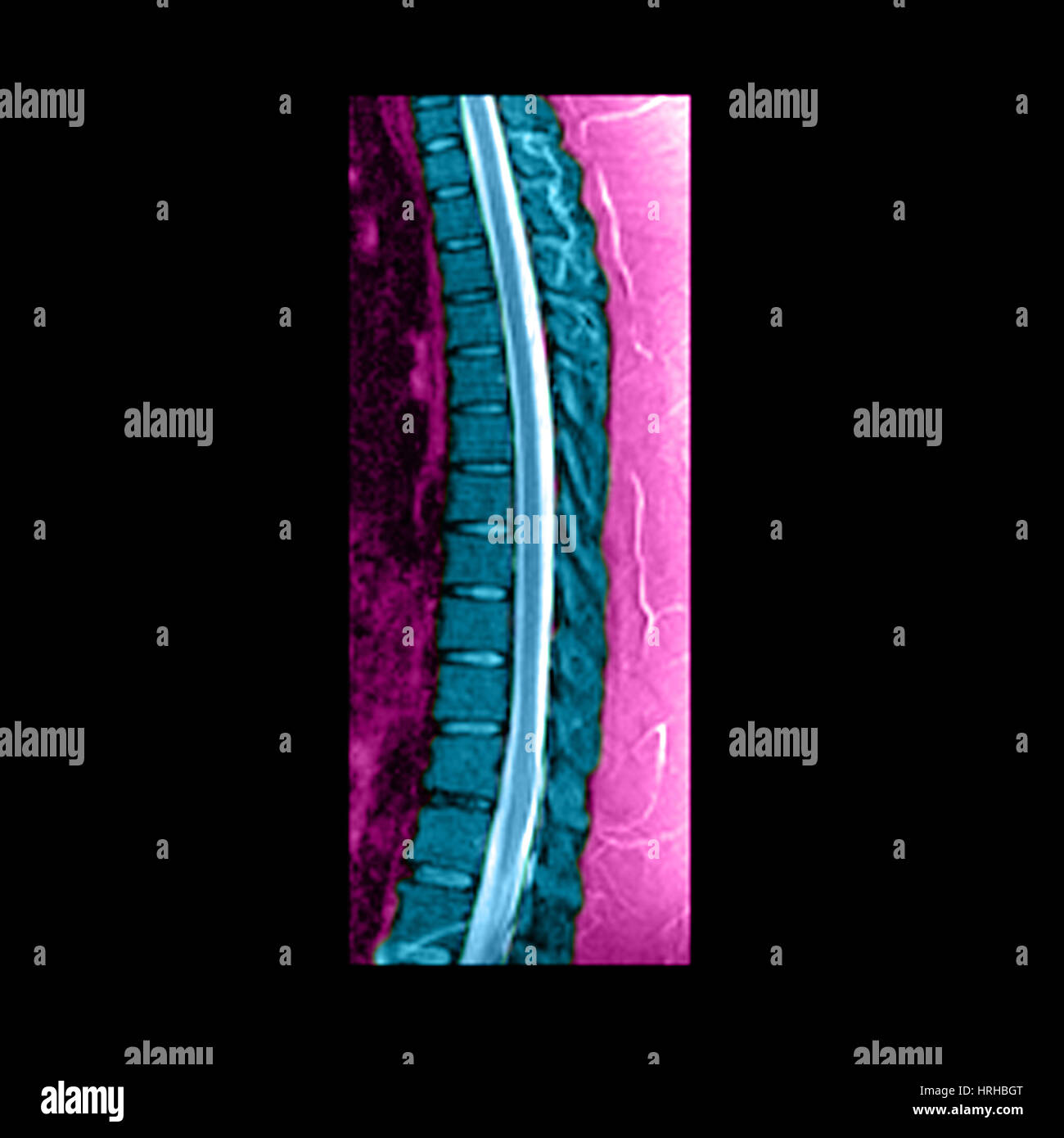 Mri of normal thoracic spine Banque de photographies et d’images à ...