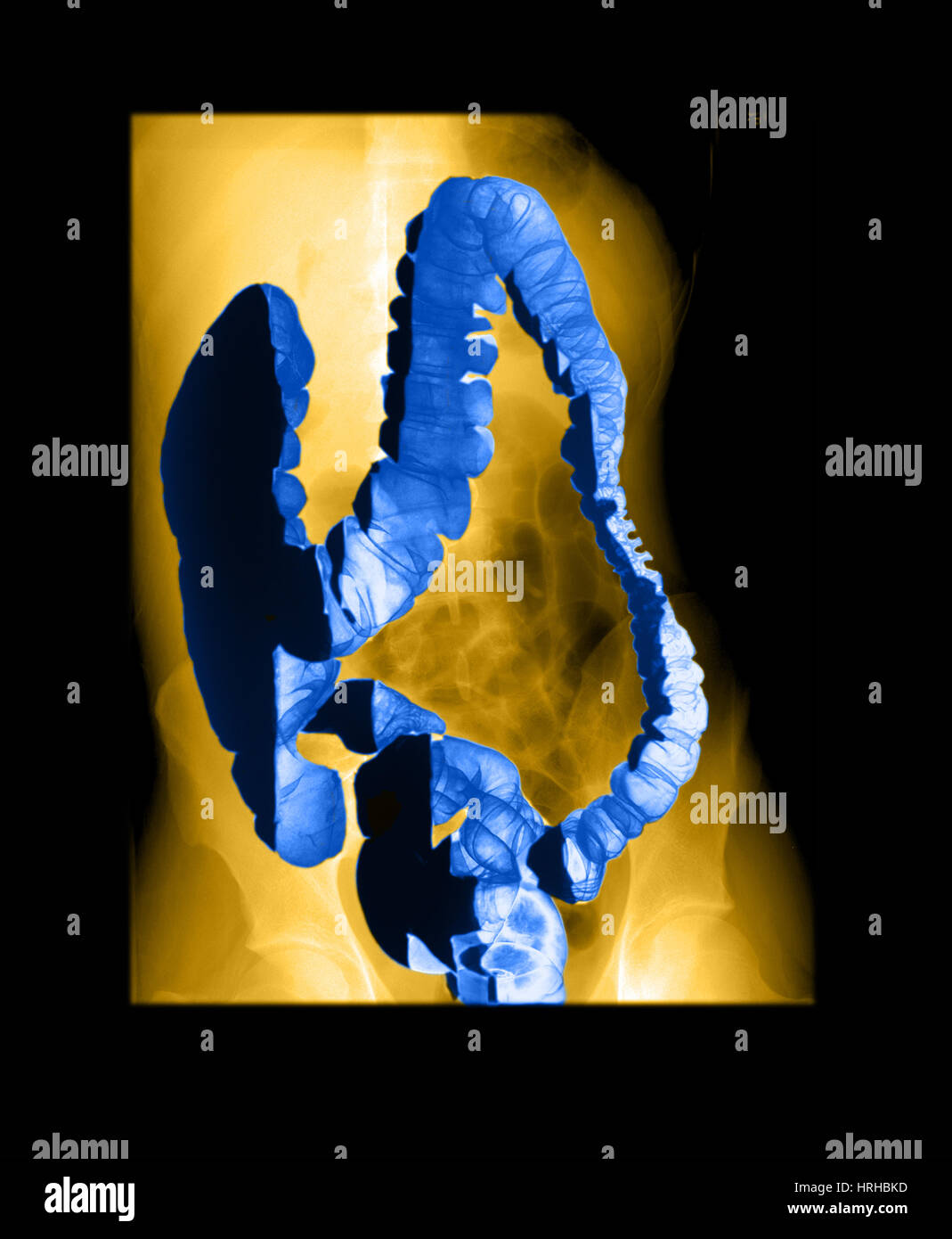 Lavement baryté Banque de photographies et d’images à haute résolution ...