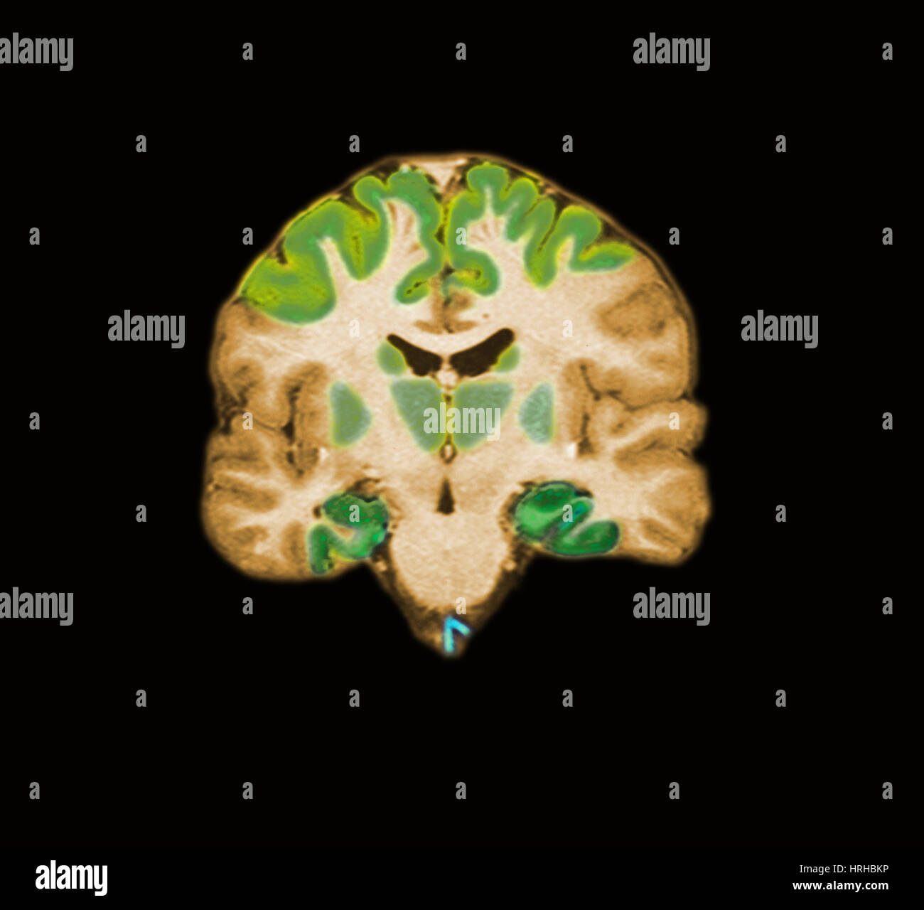 Irm anormal alzaimer Banque de photographies et d’images à haute résolution - Alamy
