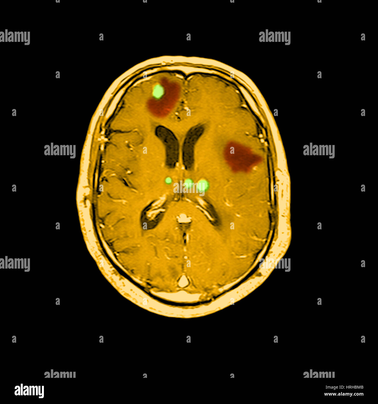 Irm anormal du cerveau Banque de photographies et d’images à haute résolution - Page 2 - Alamy