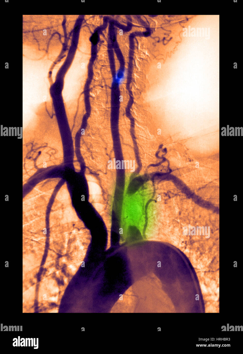 Angiographie de l'arc aortique Photo Stock - Alamy