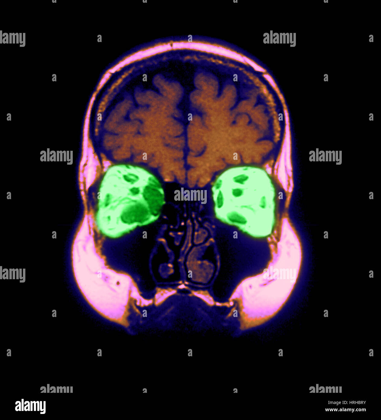 L'IRM de la maladie de Basedow Photo Stock - Alamy