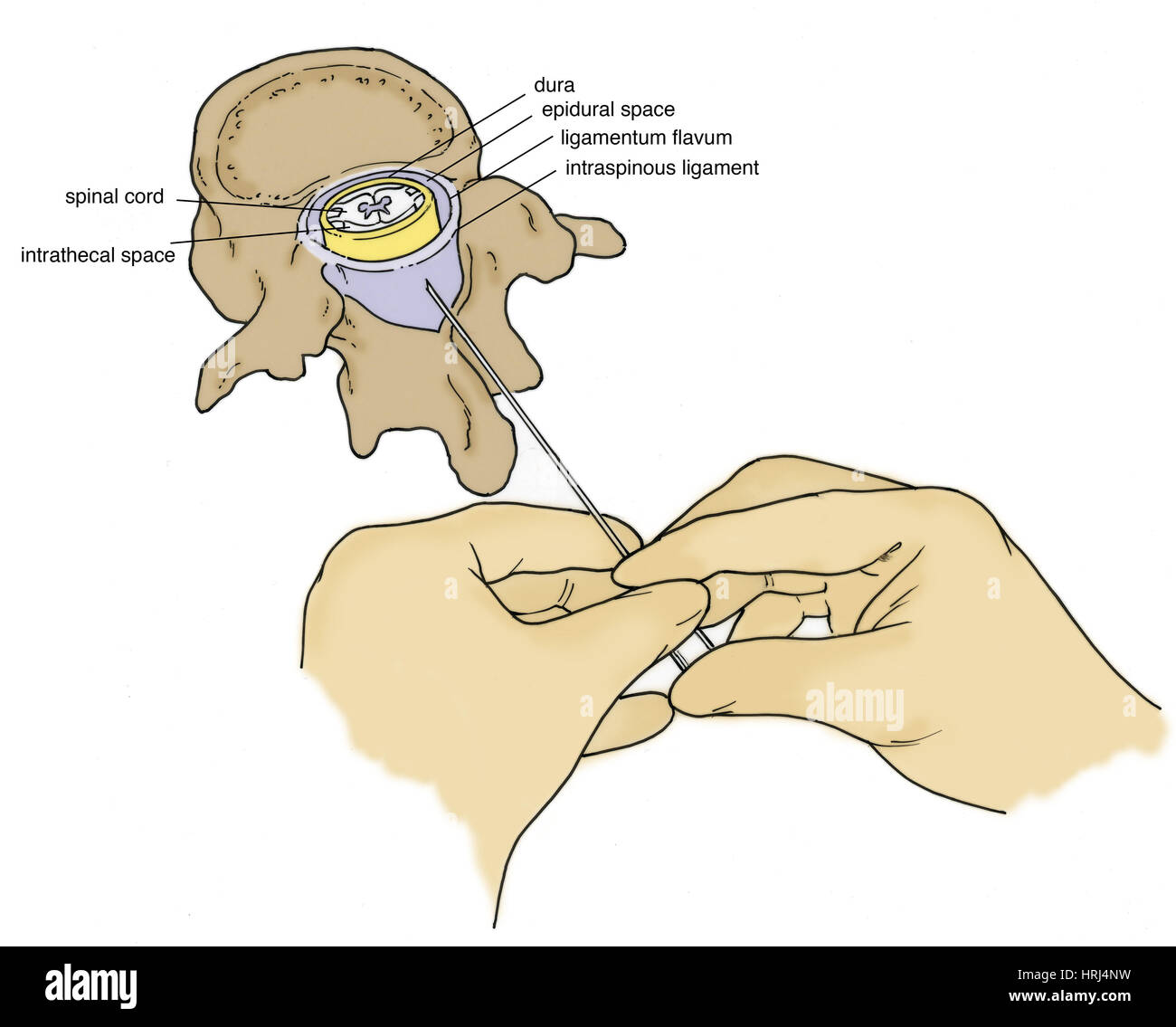 Ponction lombaire Banque de photographies et d’images à haute ...