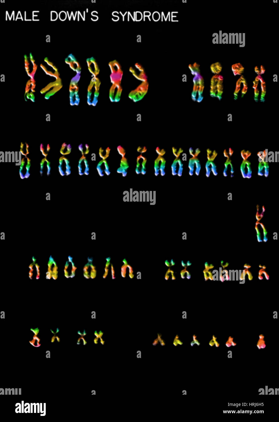 Caryotype Du Syndrome De Downs Banque De Photographies Et Dimages à