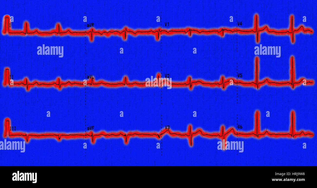 Électrocardiogramme normal Banque de photographies et d’images à haute ...