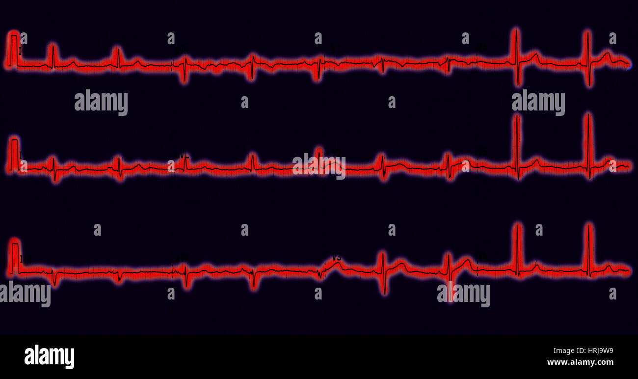 Electrocardiograma normal Banque de photographies et d’images à haute ...