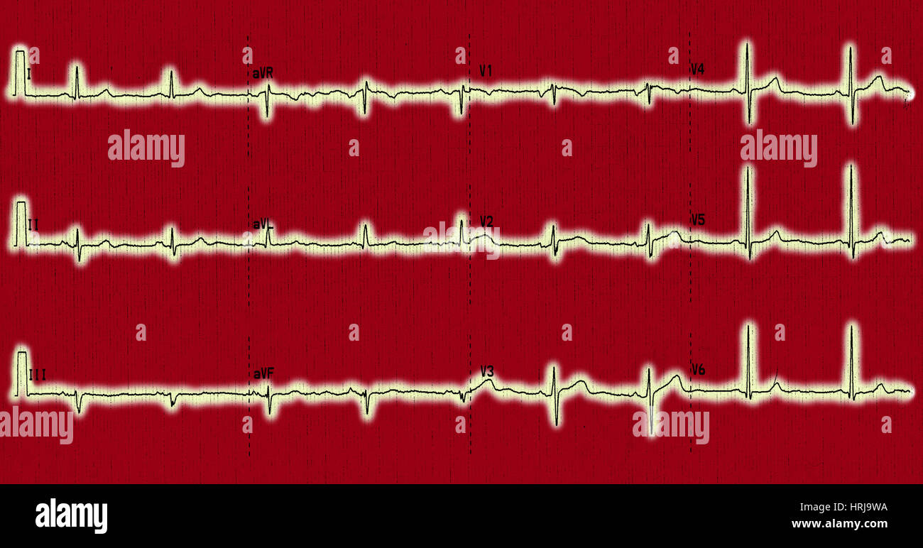 Electrocardiograma normal Banque de photographies et d’images à haute ...