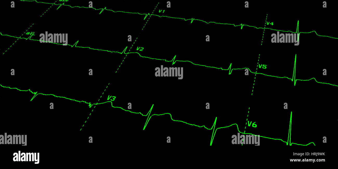 Normal Ecg Banque d'image et photos - Alamy