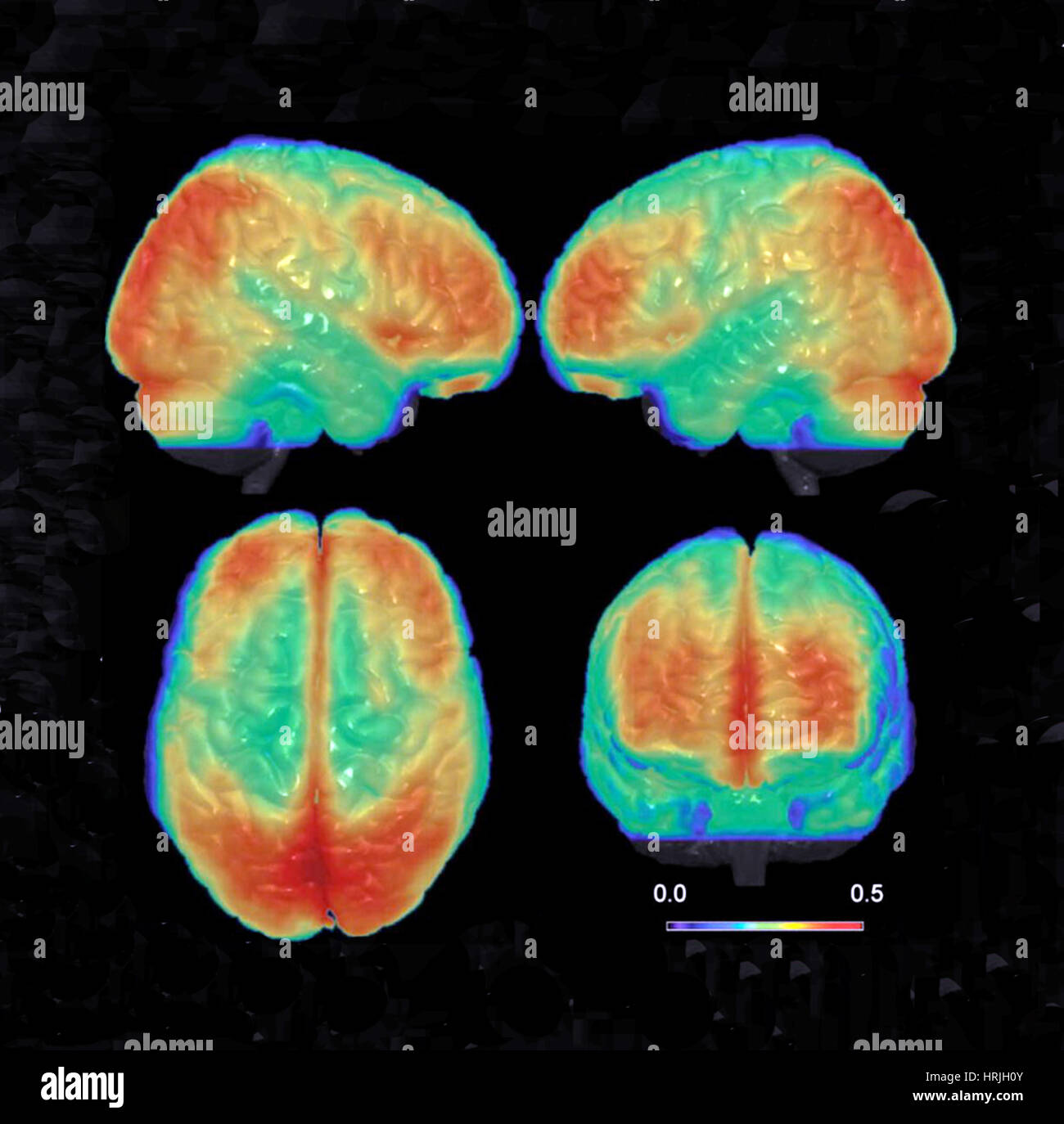 Irm anormal du cerveau Banque de photographies et d’images à haute résolution - Alamy