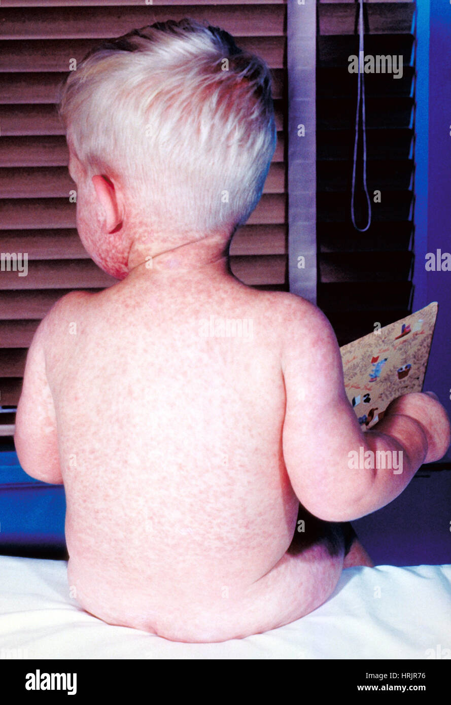 Rougeole De 3 Jours Banque d'image et photos - Alamy