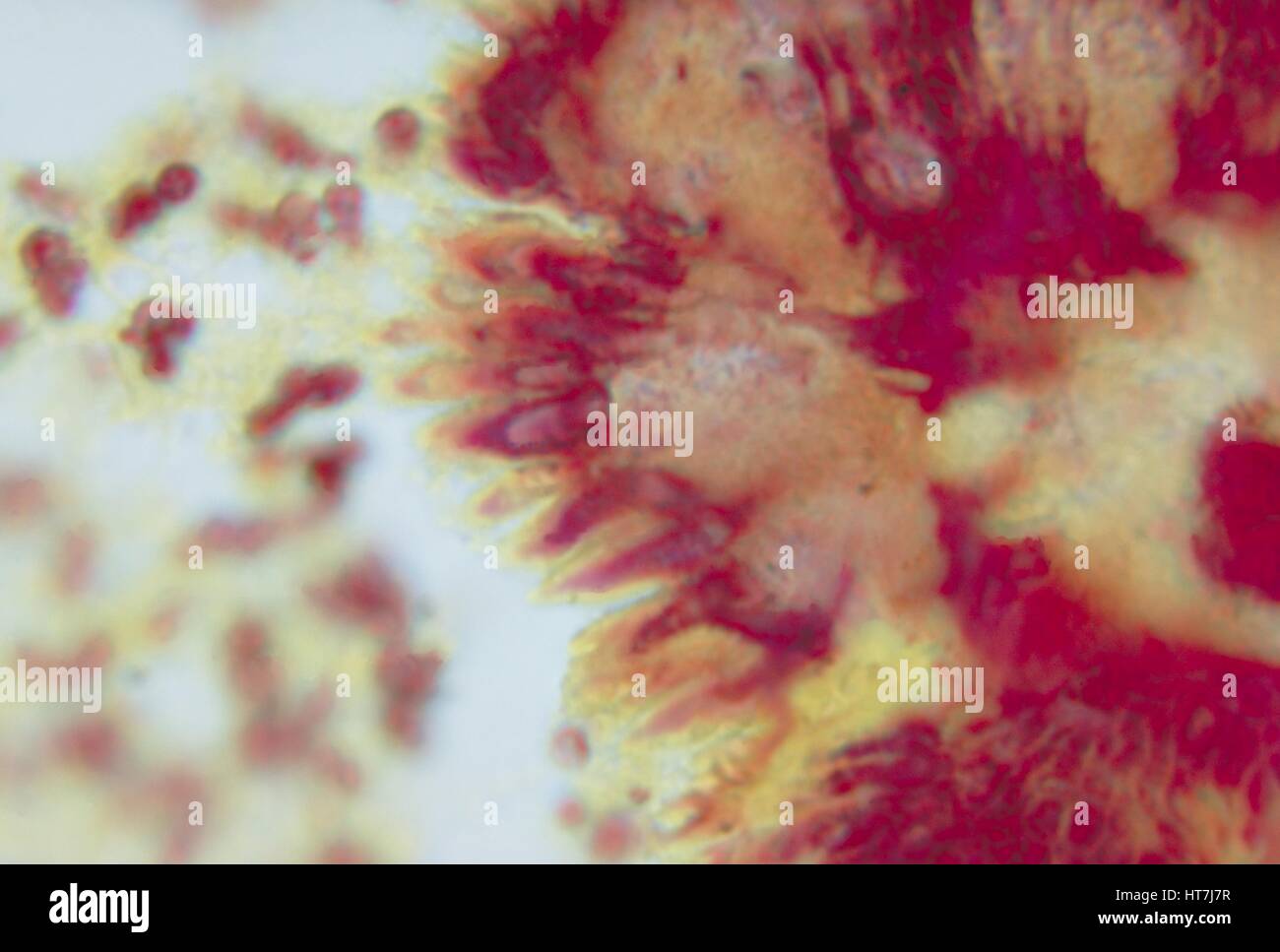 Istopathologic Micrograph de changements dans un cas d'botryomycosis ...