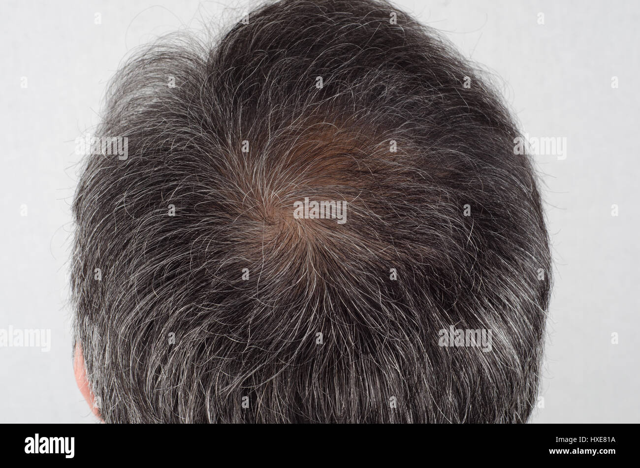 La perte de cheveux et les cheveux gris, tête d'homme avec des ...