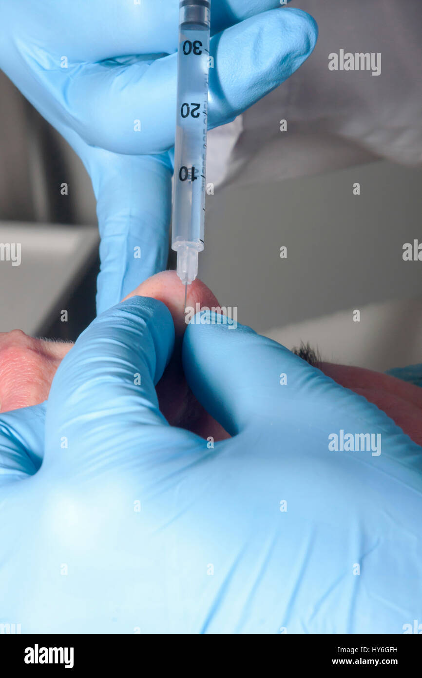 Cancer du nez Banque de photographies et d’images à haute résolution ...