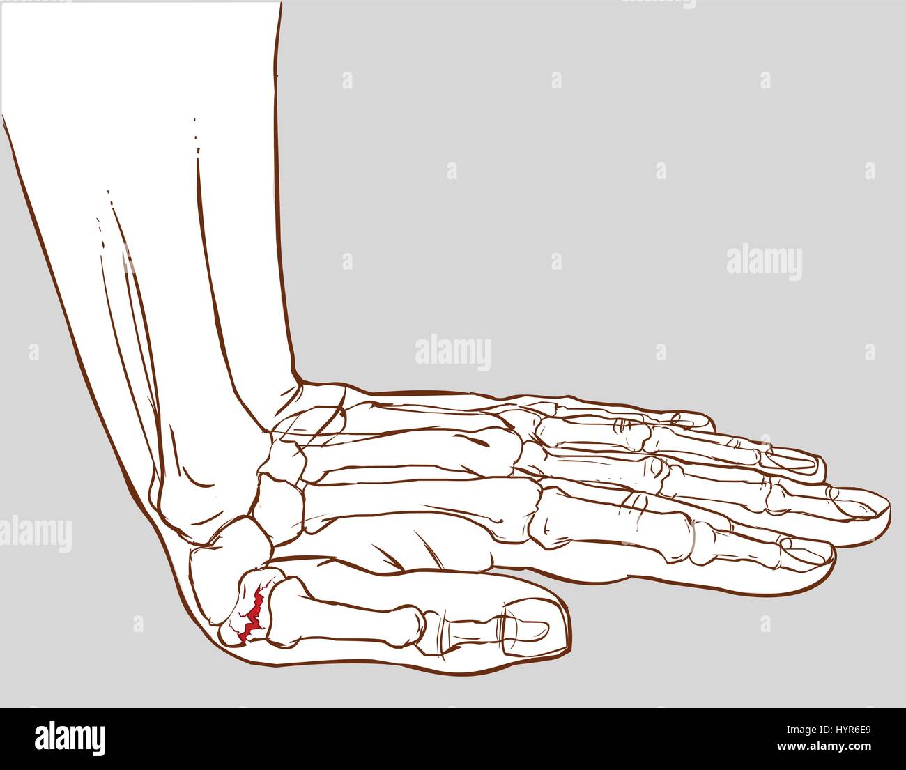Fond blanc vector illustration d'une fracture de la main Image ...
