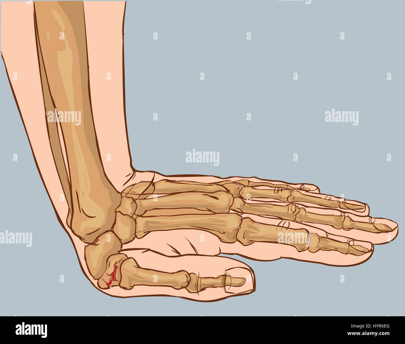 Fond blanc vector illustration d'une fracture de la main Image ...