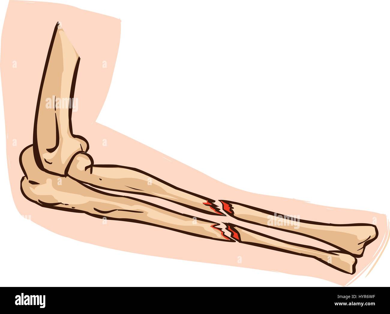 Fractured ulna Banque d'images vectorielles - Alamy