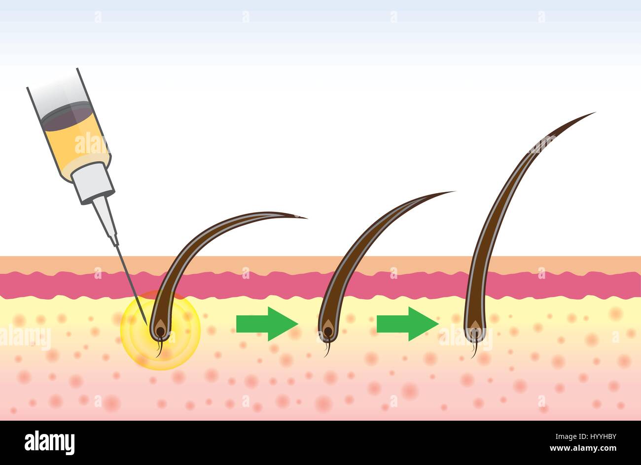 Follicule pileux Banque de photographies et d’images à haute résolution ...