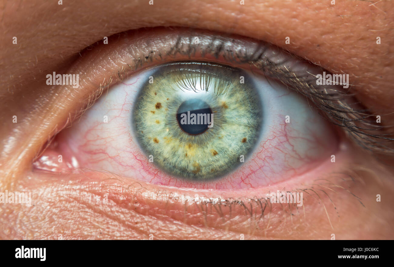 L'oeil humain avec beaucoup de vaisseaux sanguins Photo Stock - Alamy