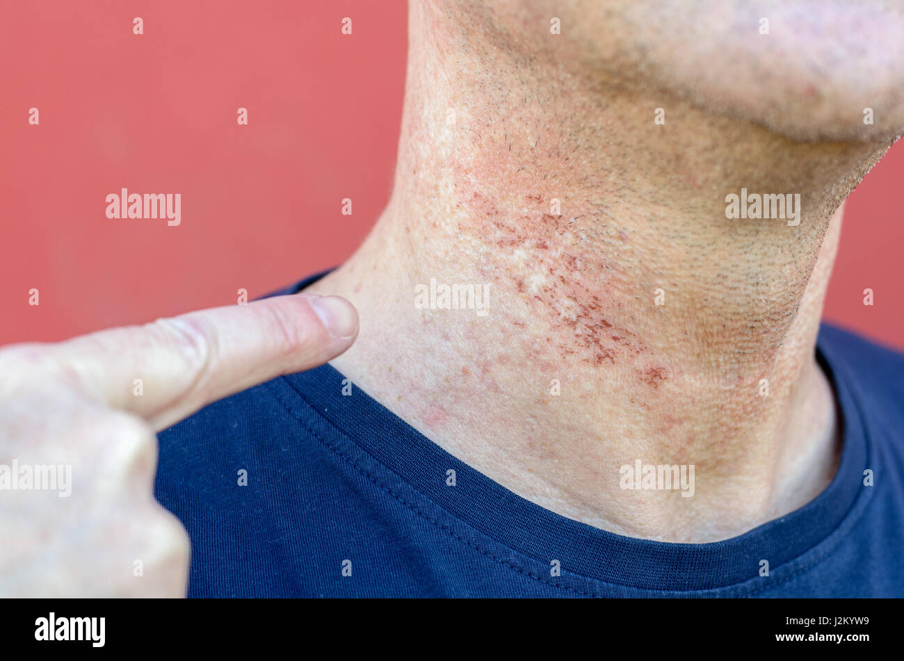 Irritation peau Banque de photographies et d’images à haute résolution ...
