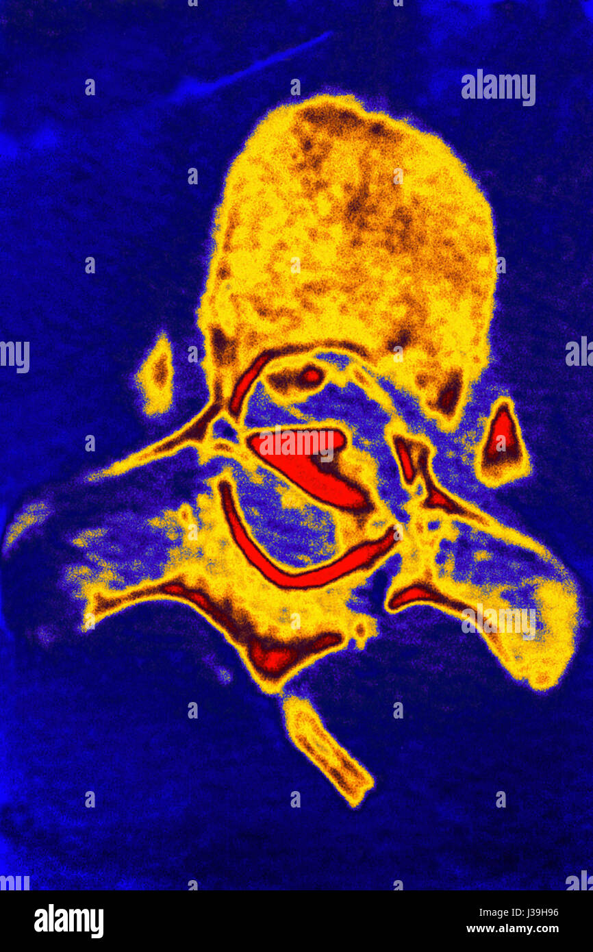 La fracture vertébrale, numérisation Photo Stock - Alamy