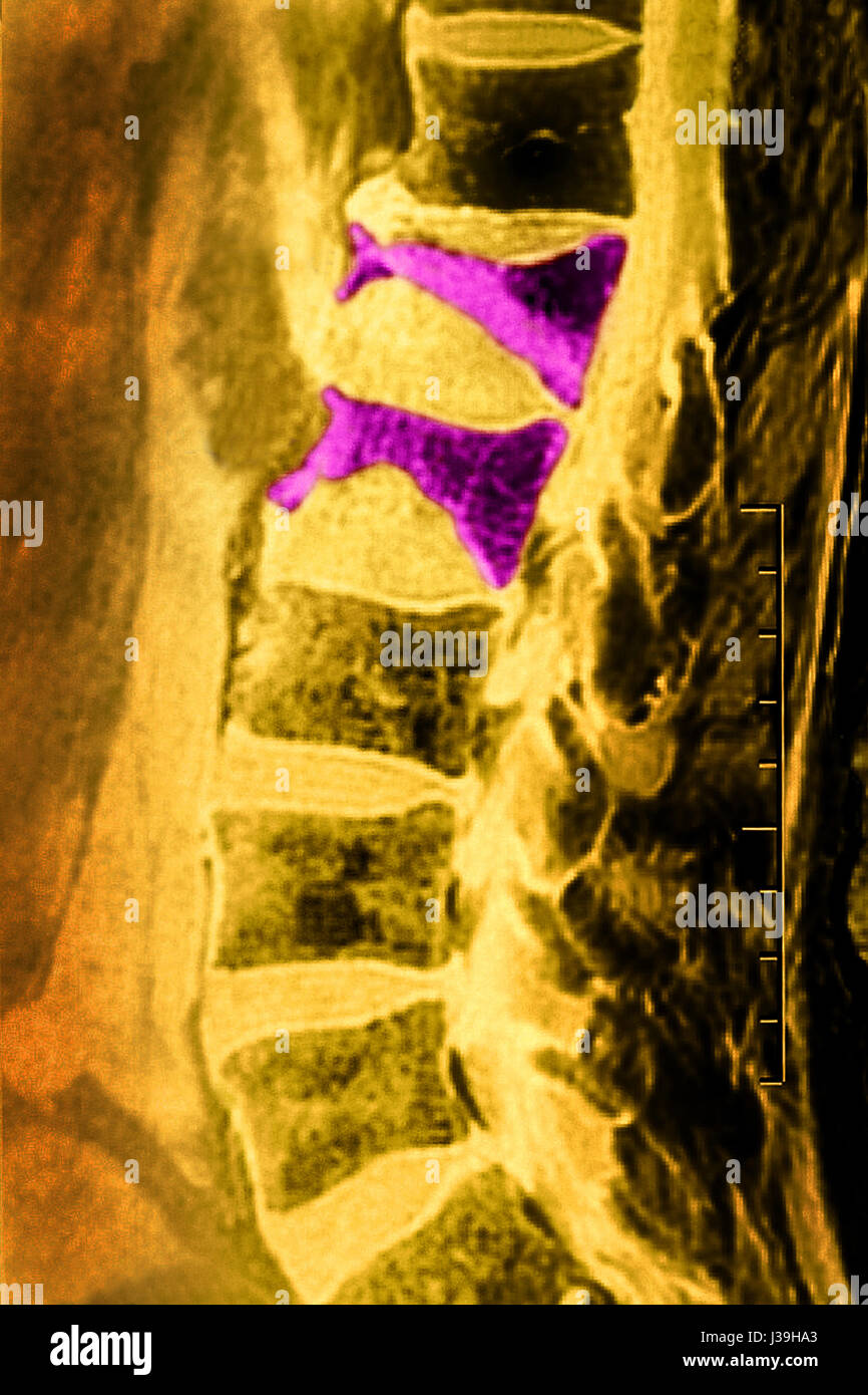 Fracture De Compression Vertébrale Banque d'image et photos - Alamy